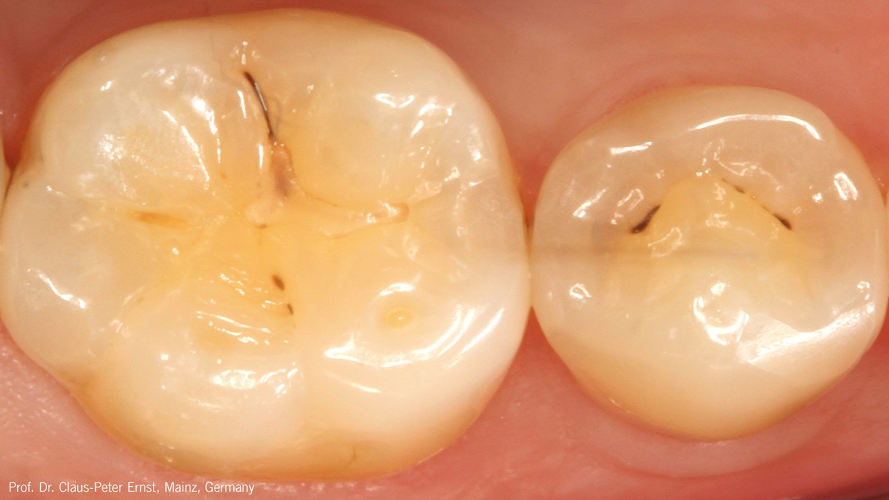 Charisma® Bulk Flow ONE