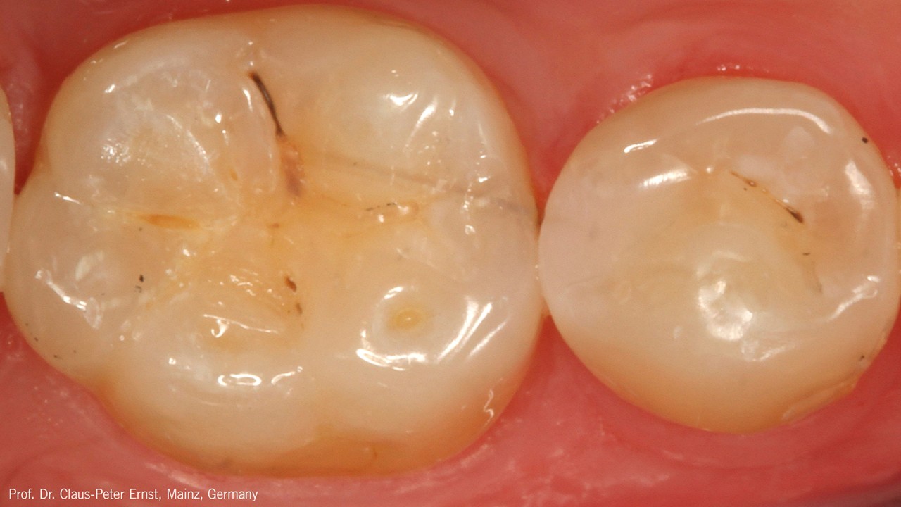 Charisma® Bulk Flow ONE