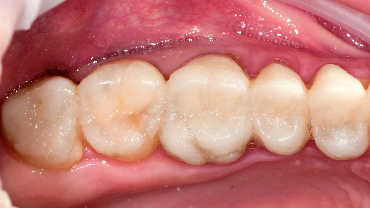 Charisma® Bulk Flow ONE