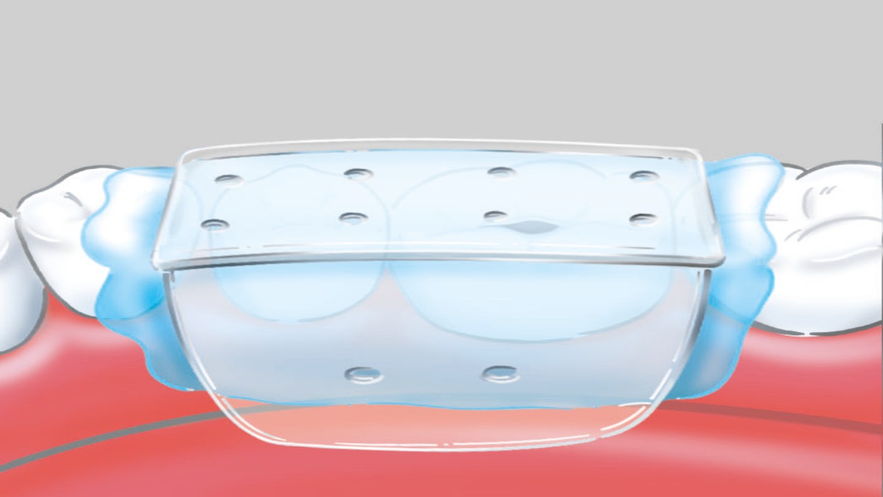 MEMOSIL 2 - the expert for special indications