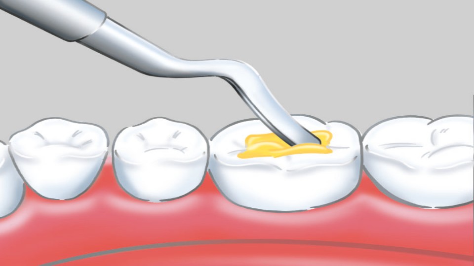 MEMOSIL 2 - the expert for special indications