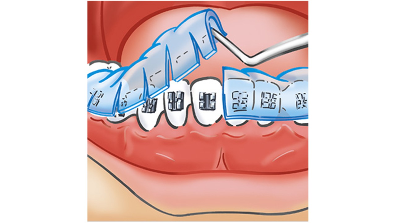 MEMOSIL 2 - the expert for special indications
