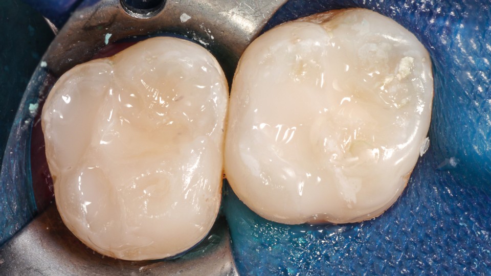 Venus Bulk Flow ONE - Your flowable bulk-filling composite