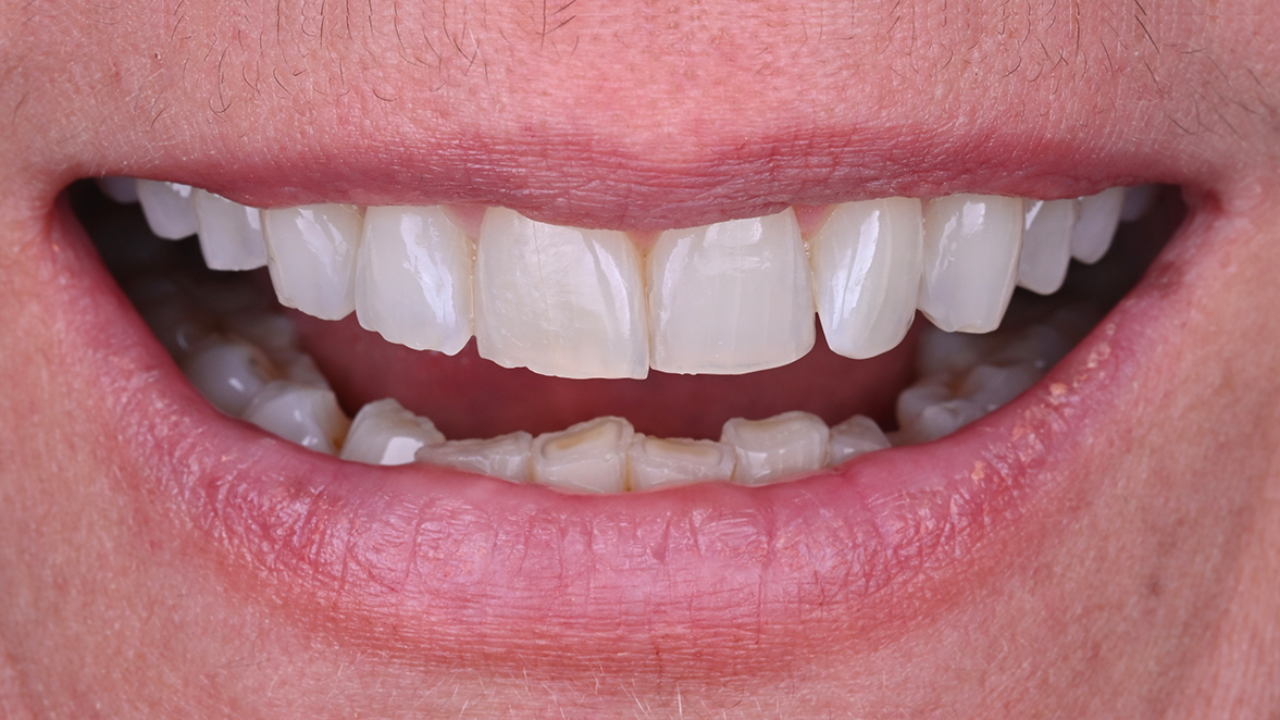 Kulzer Vivida Home Kit