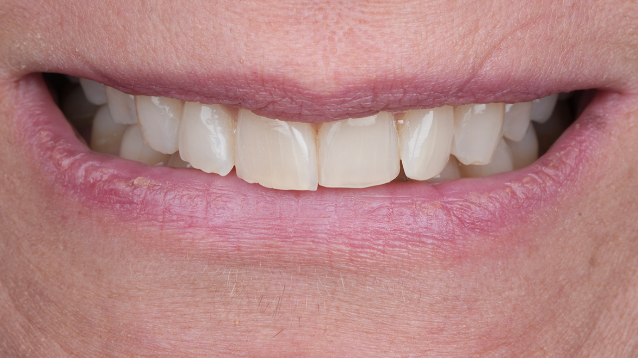 Kulzer Vivida Home Kit